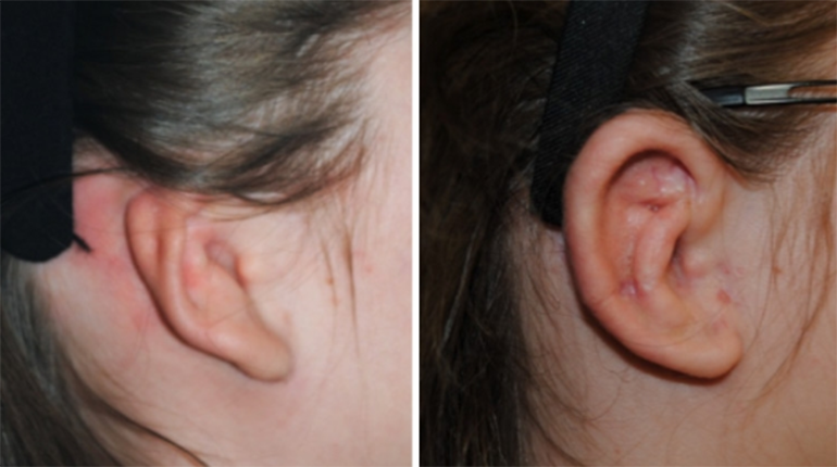 Microtia, la condición que afecta a uno de cada mil niños en países ...